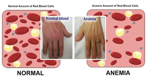 Penyakit Anemia-Gejala, Penyebab Dan Rawatan - TCER.MY