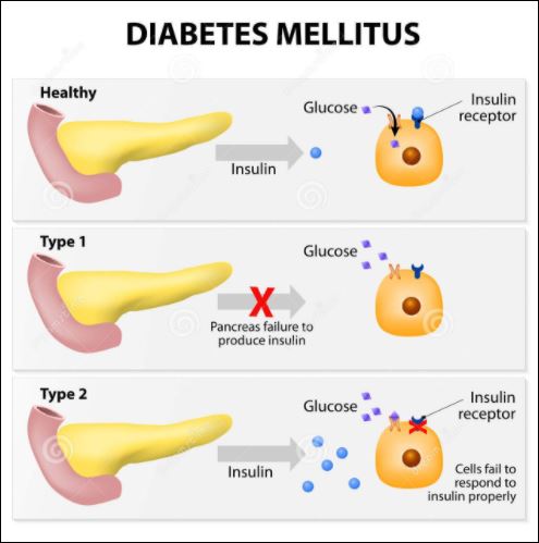 Penyakit Diabetes - Punca, Gejala Dan Langkah Pencegahan - TCER.MY
