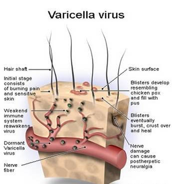 Penyakit Kayap- Tanda,Komplikasi Dan Juga Rawatan - TCER.MY