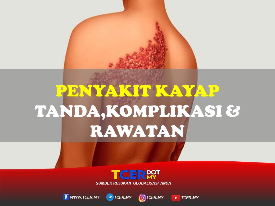Penyakit Kayap- Tanda,Komplikasi Dan Juga Rawatan - TCER.MY
