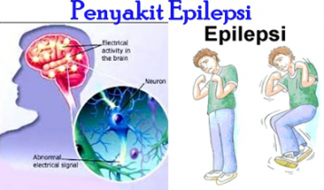 Penyakit Sawan (Epilepsi)- Punca,Tanda, Rawatan Dan Juga Pencegahan ...