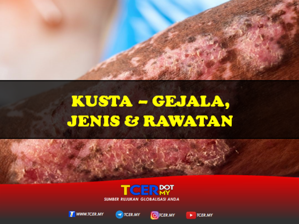 Kusta - Gejala, Jenis Dan Rawatan - TCER.MY