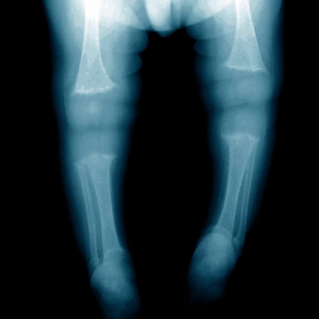 Riket - Gejala, Rawatan Dan Pencegahan - TCER.MY