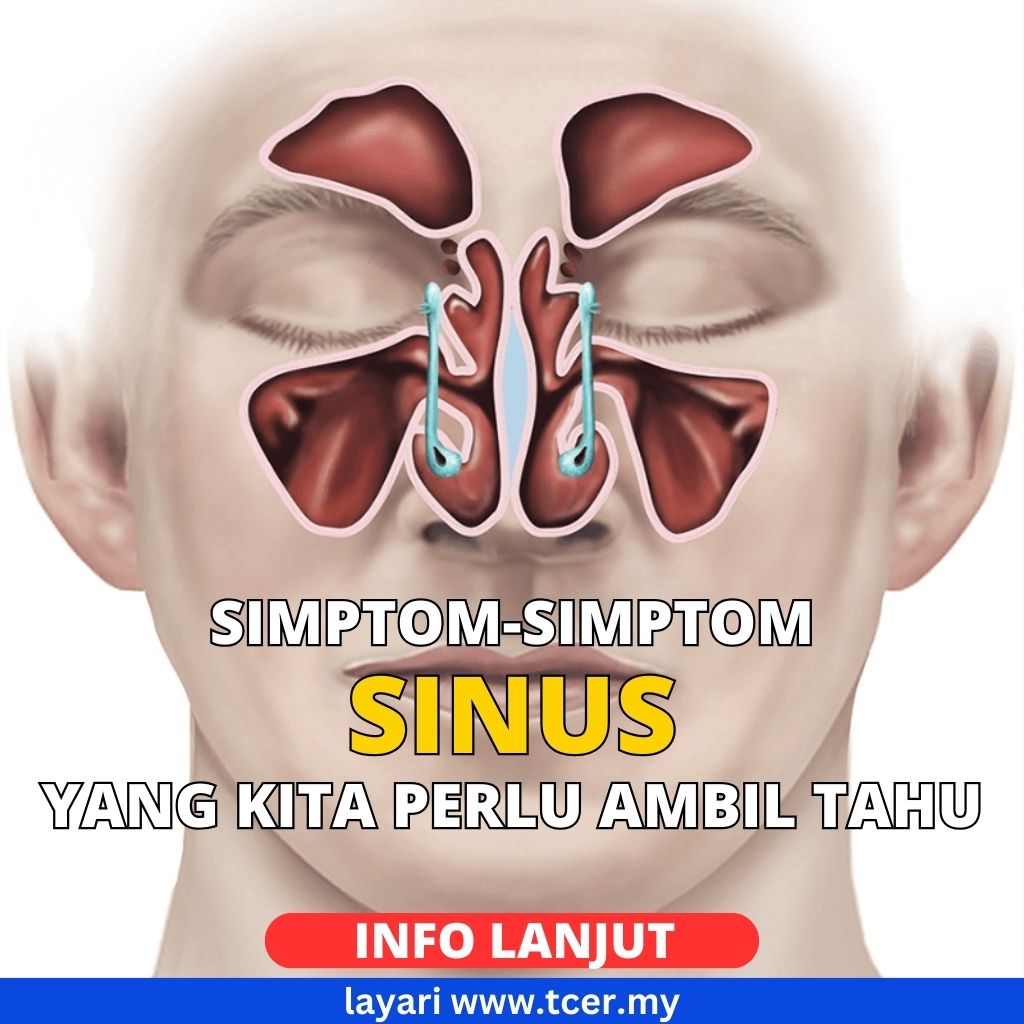 Sinus: Terdapat 4 Tahap Yang Perlu Diawasi - TCER.MY