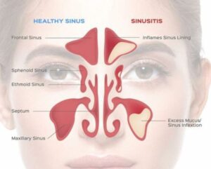 Sinus: Terdapat 4 Tahap Yang Perlu Diawasi - TCER.MY