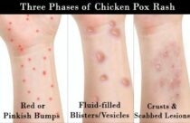 3 Fasa Chicken Pox: Simptom, Punca, Risiko, Komplikasi & Rawatan - TCER.MY