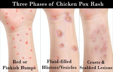 3 Fasa Chicken Pox: Simptom, Punca, Risiko, Komplikasi & Rawatan - TCER.MY