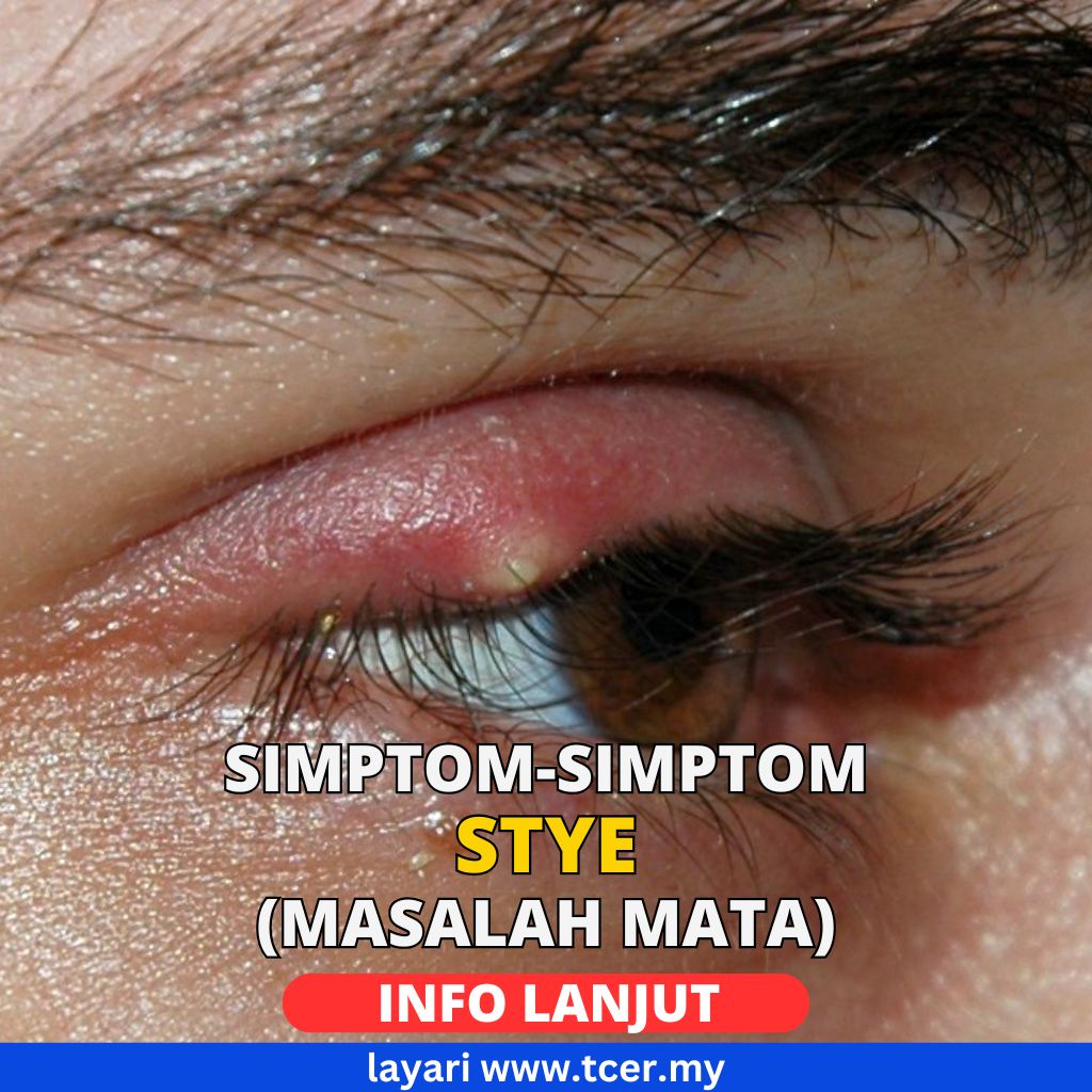 Stye: Jenis, Tanda & Gejala, Punca Dan Cara Merawat - TCER.MY