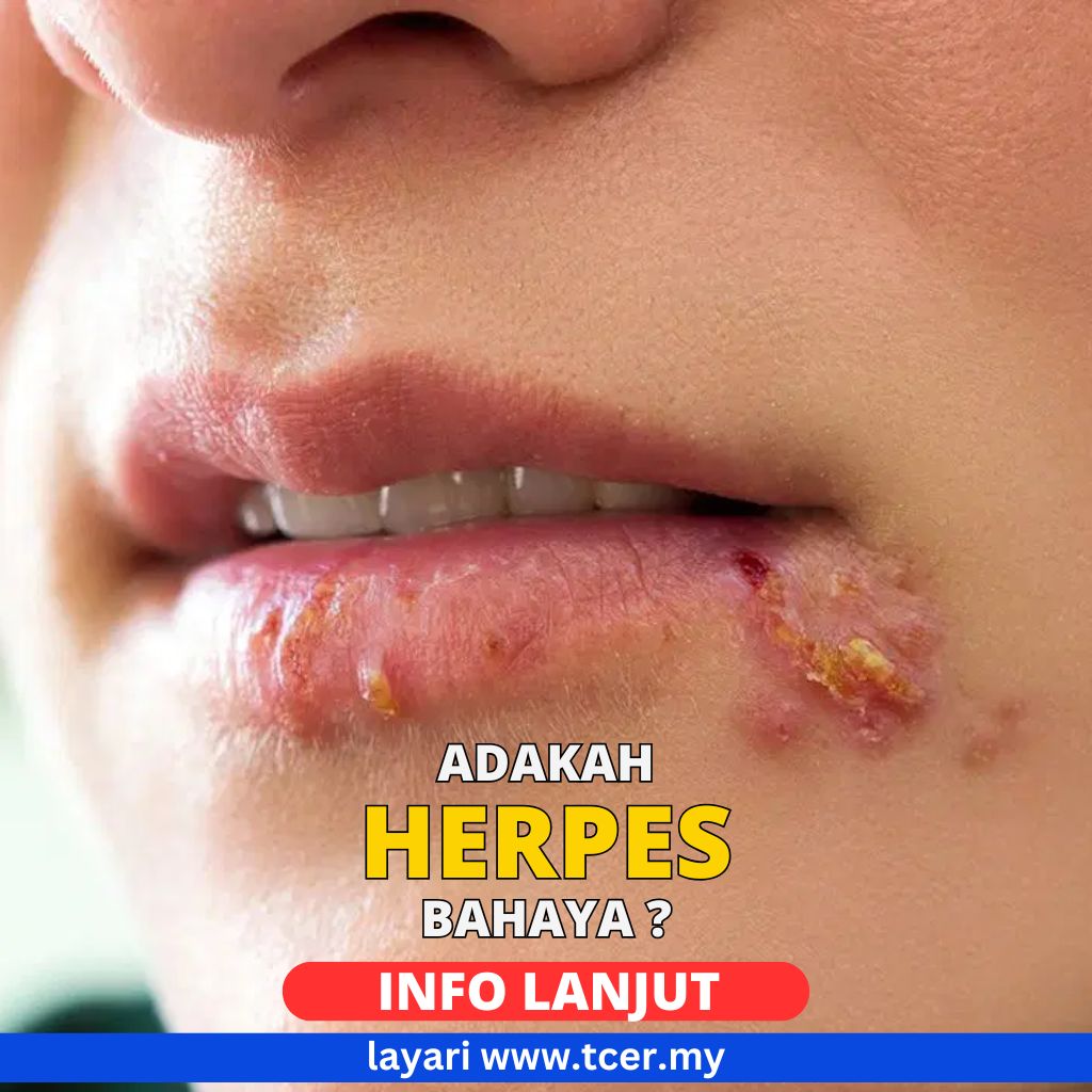 Adakah Herpes Simplex Virus (HSV) Bahaya & Boleh Merebak? - TCER.MY
